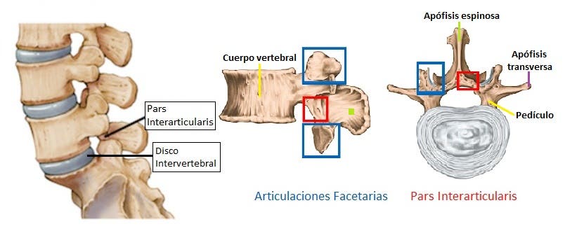 Espondilolisis - Espondilolistesis: Qué es, causas, síntomas ...