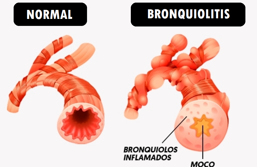 Bronquiolitis Qué Es Causas Síntomas Tratamiento Y Consejos