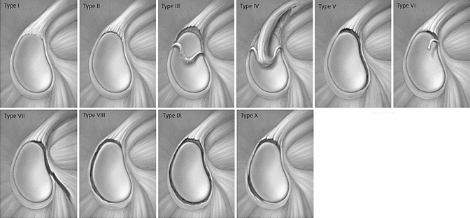 Lesión de SLAP - Qué es, causas, síntomas, tratamiento y consejos ...