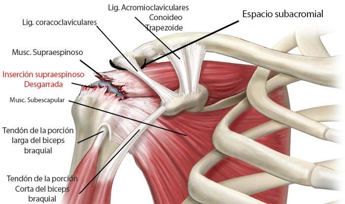 Lesión De Hombro Tendinitis Del Supraespinoso ¿qué Es Causas