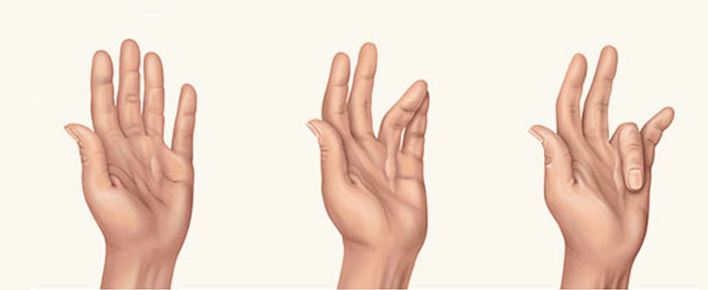 Sindrome de Dupuytren: Qué es, causas, síntomas, tratamiento y consejos ...