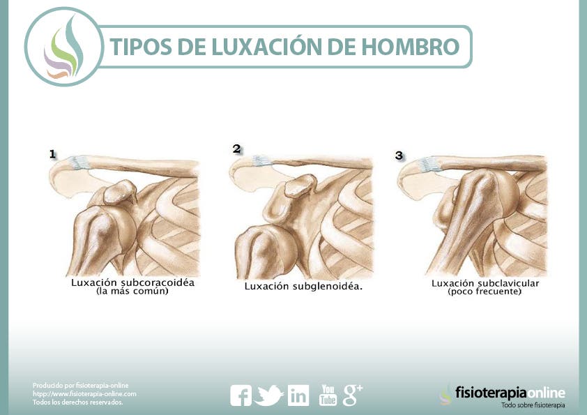 Luxación de hombro. Qué es y cuales son sus tipos | FisioOnline