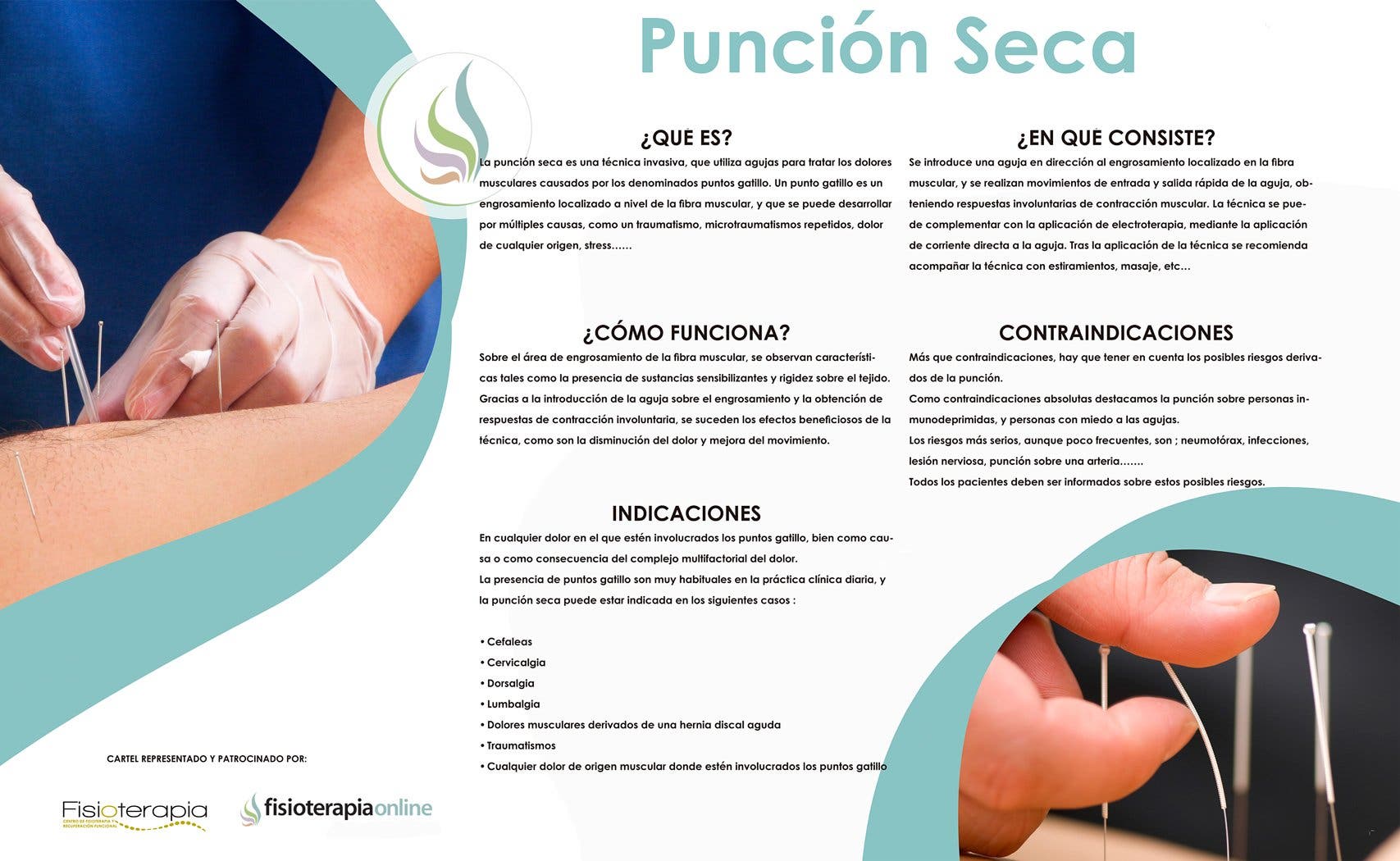 Punción seca. Está de moda pero... ¿Sabes bien lo qué es? | FisioOnline