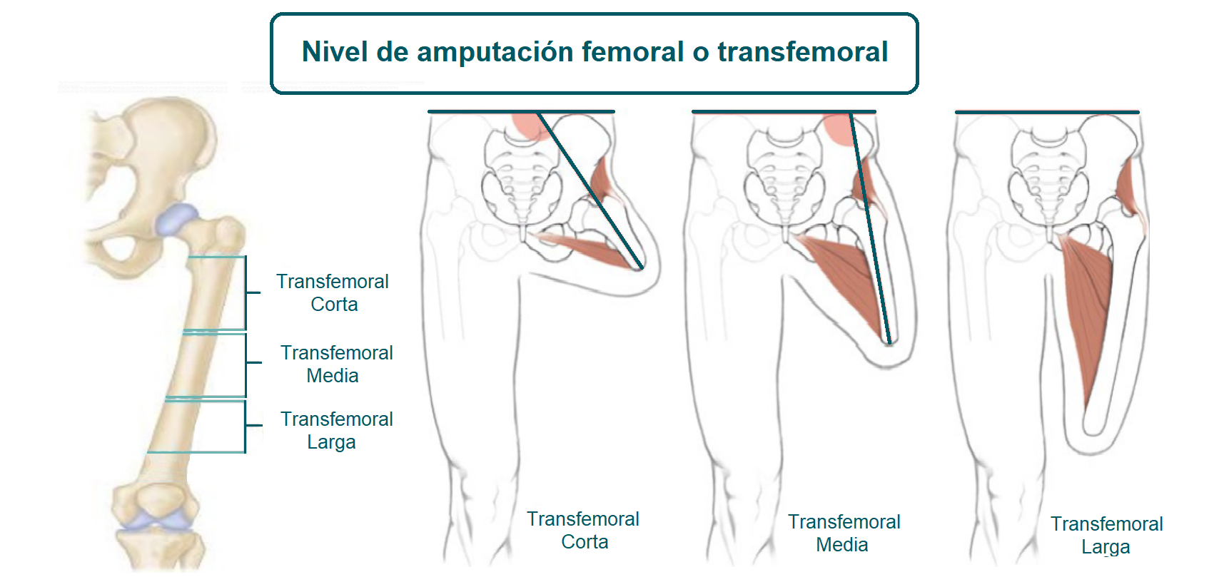Amputación Femoral Qué Es Causas Síntomas Tratamiento Y Consejos