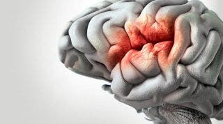 Hemiplejia - ACV - Ictus: Qué es, causas, síntomas, tratamiento y ...