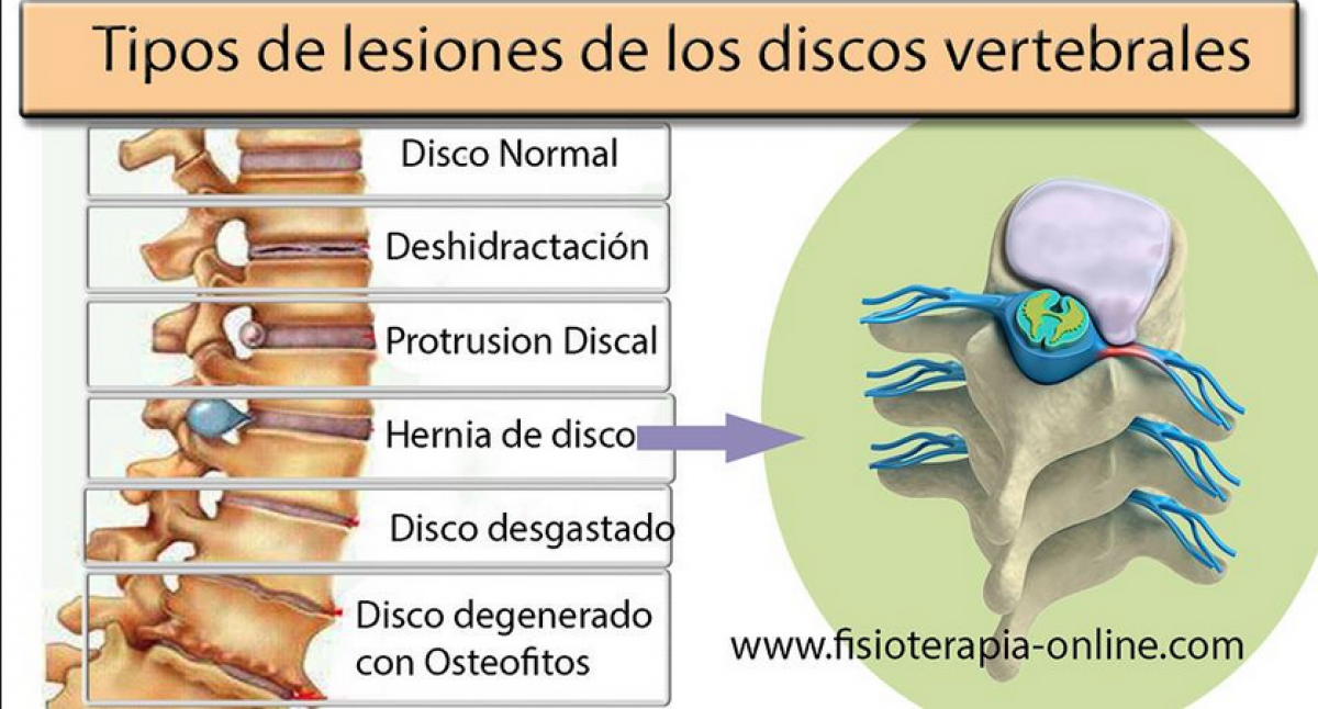 Lesiones más frecuentes del disco intervertebral | Fisioterapia Online