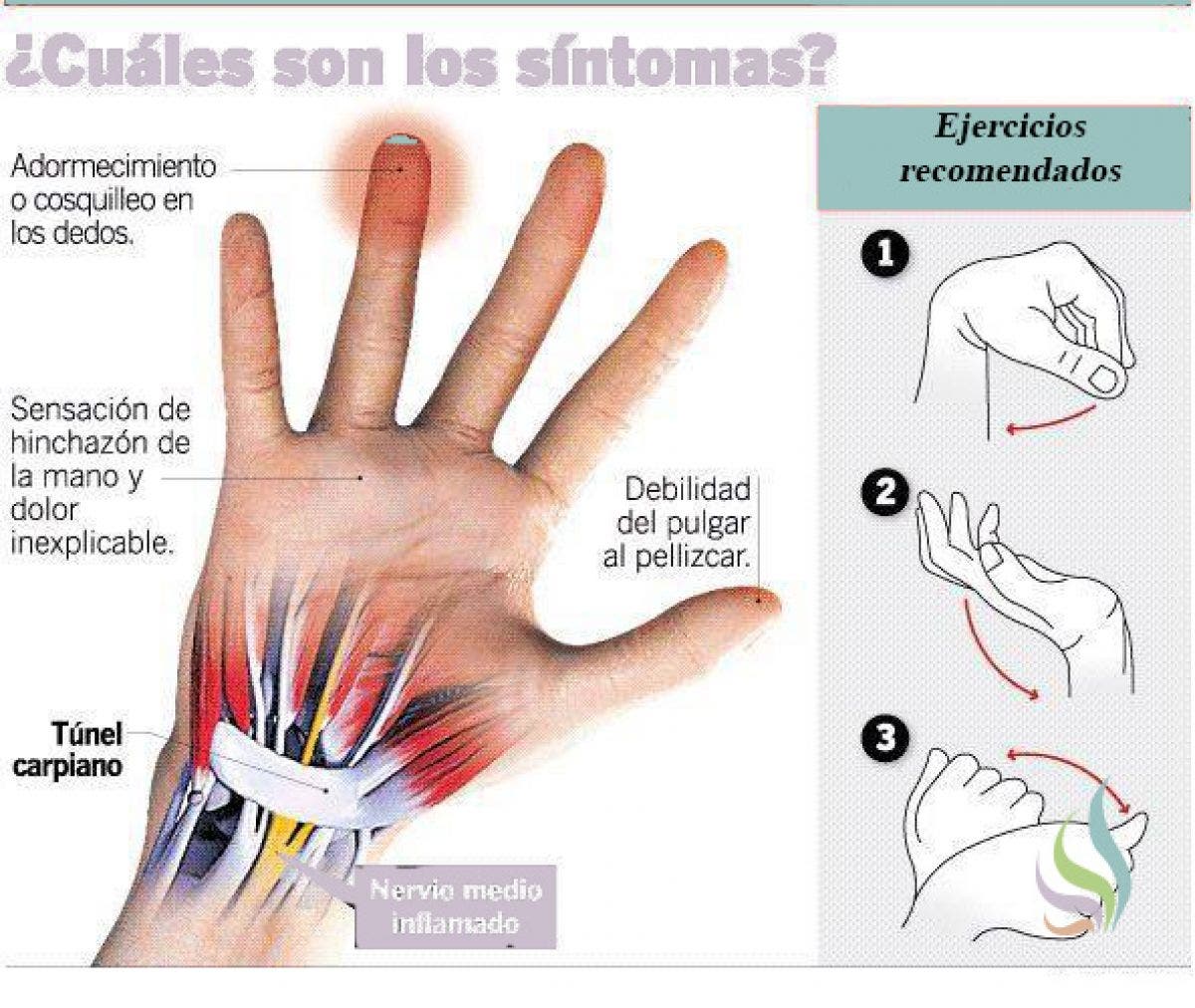 El síndrome del túnel carpiano, aprende qué es, cómo se produce y qué ... El síndrome del túnel carpiano, aprende qué es, cómo se produce y qué ...