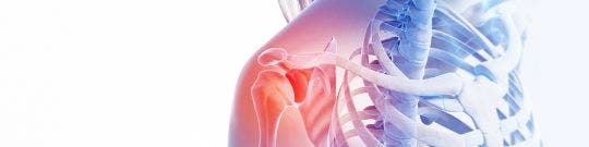 Hombro - Brazo: Qué es, causas, síntomas, tratamiento y consejos ...