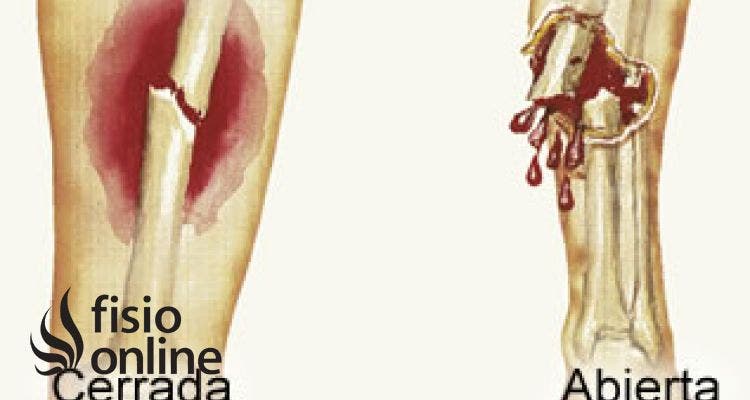 Fracturas óseas Qué Es Causas Tipos Sintomas Y Tratamiento