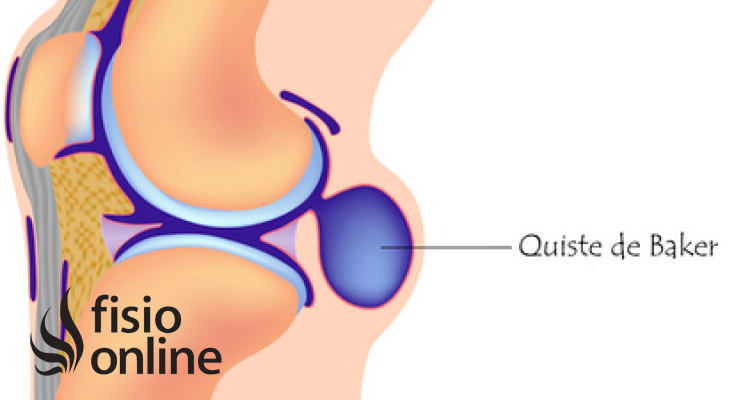 Quiste de Baker: ¿Qué es y por qué aparece? | Fisioterapia Online