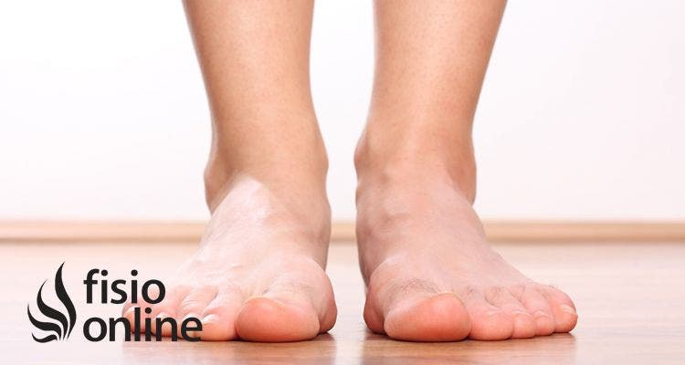 Pie Plano, Causas, Síntomas y Tratamiento Recomendado. | Fisioterapia ...