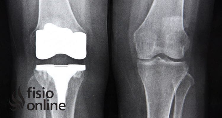 Tratamiento y recuperación de artrosis de rodilla. Cirugía y ...