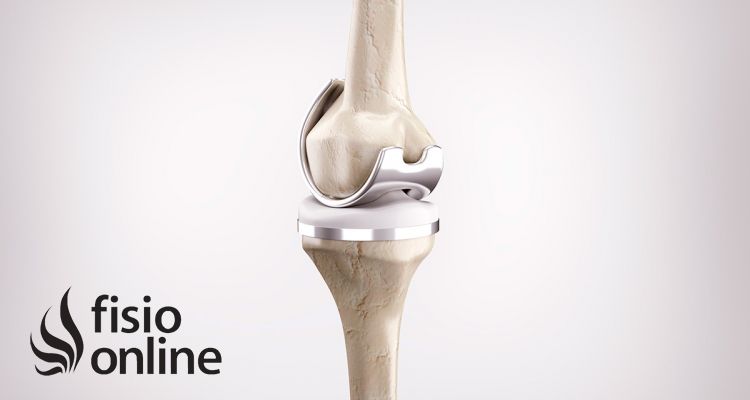 Lo que debes saber sobre las prótesis de rodilla | FisioOnline