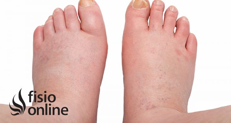 Inflamación y edema… ¿Acaso no es lo mismo? | FisioOnline