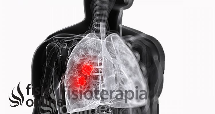 ¿Qué es un Absceso Pulmonar? | FisioOnline