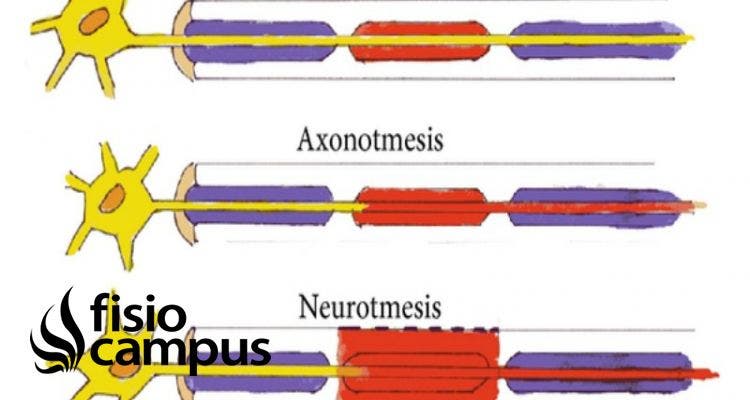 Axonotmesis | Qué es, qué estructuras afecta, síntomas, signos clínicos ...