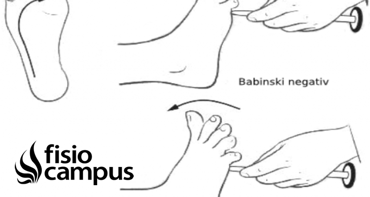 Babinski | Qué es, características, cómo se valora, tiempo de aparición ...