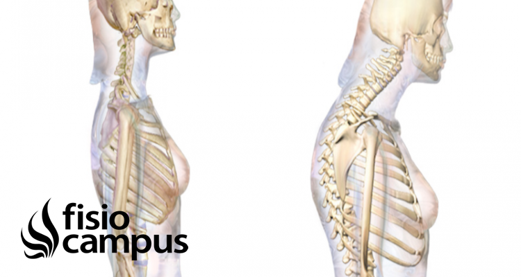 Cifosis | Qué es, por qué se produce, cuáles son sus síntomas y a quién ...