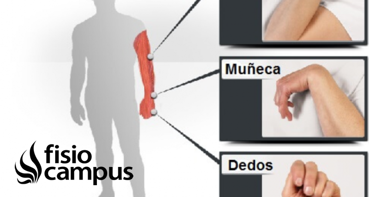 Espasticidad | Qué es, características, en qué patologías aparece, por ...