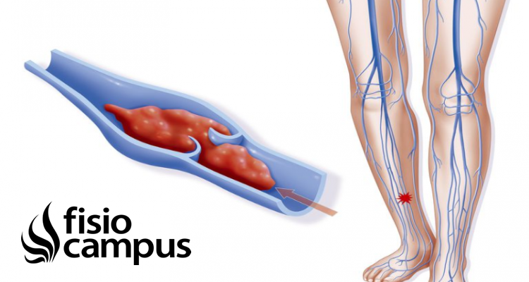 Flebitis | Qué es, qué estructuras afecta, síntomas, signos clínicos ...