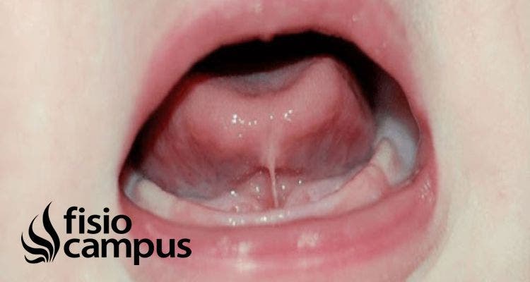 Frenillo lingual corto | Qué es, qué estructuras afecta, síntomas ...