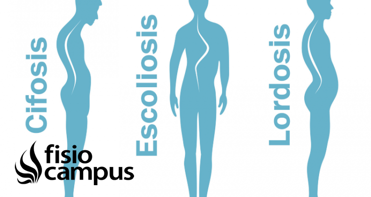 Lordosis | Qué es, por qué se produce, cuáles son sus síntomas y a ...