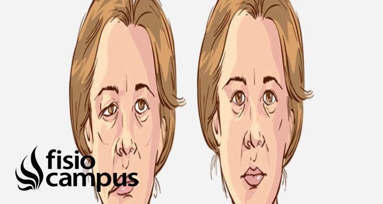 Parálisis | Qué es, qué estructuras afecta, síntomas, signos clínicos ...