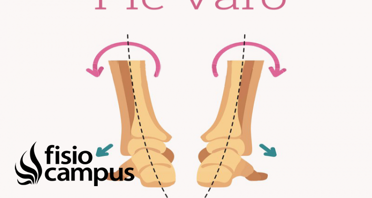 Pie varo | Qué es, causas, síntomas, a quién afecta y tratamiento