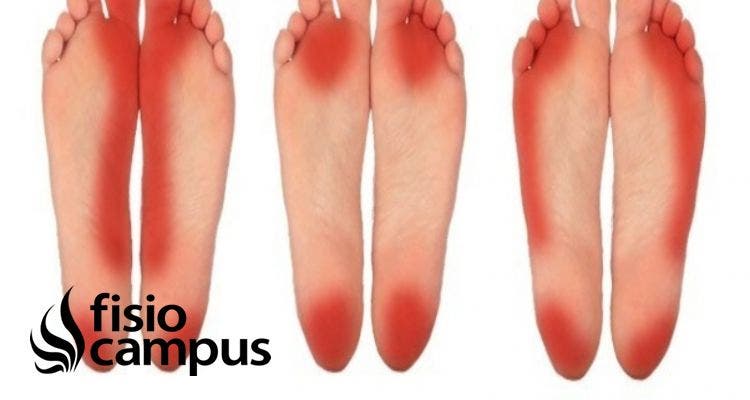 Pie supinador | Qué es, causas, síntomas, a quién afecta y tratamiento