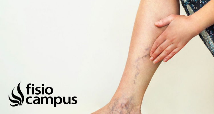 Tromboflebitis | Qué es, qué estructuras afecta, síntomas, signos ...