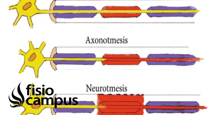 Axonotmesis | Qué es, qué estructuras afecta, síntomas, signos clínicos ...