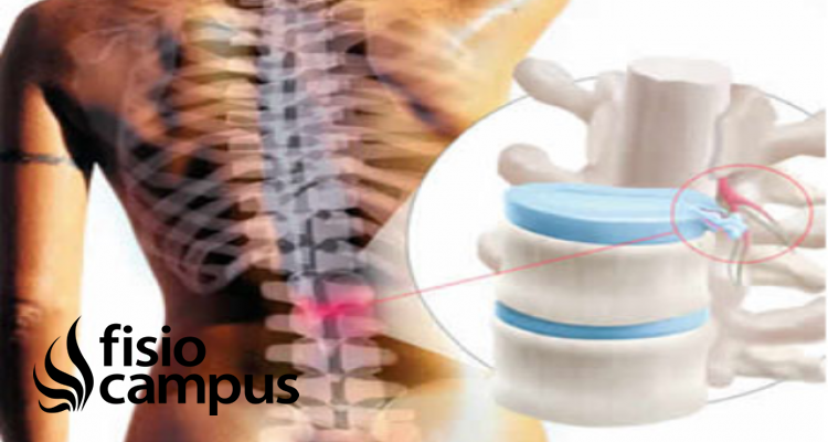 Dolor discogénico | Qué es, características, en qué patologías aparece ...