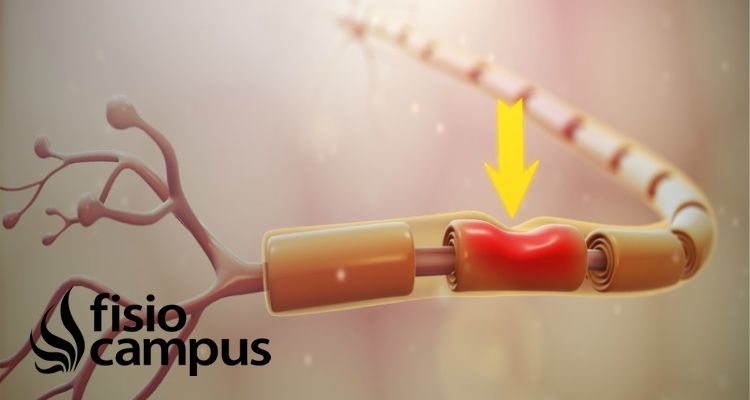 Neuropraxia | Qué es, qué estructuras afecta, síntomas, signos clínicos ...