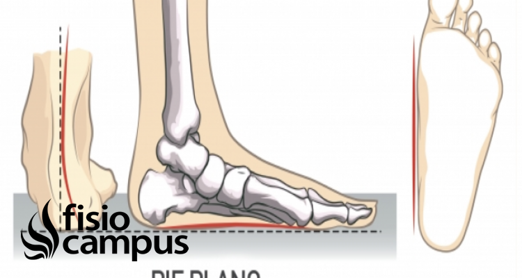 Pie plano | Qué es, causas, síntomas, a quién afecta y tratamiento