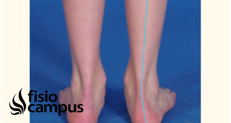 Pie valgo | Qué es, causas, síntomas, a quién afecta y tratamiento