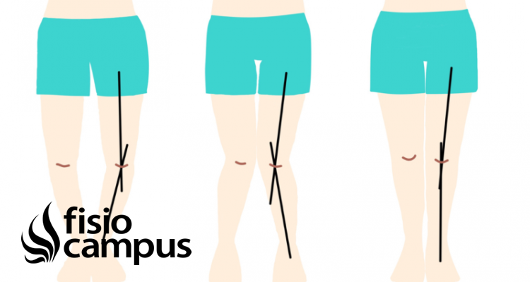 Valgo de rodilla | Qué es, causas, síntomas, a quién afecta y tratamiento
