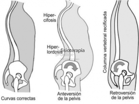 Anteversión | Qué es, causas, qué estructuras están involucradas y a ...