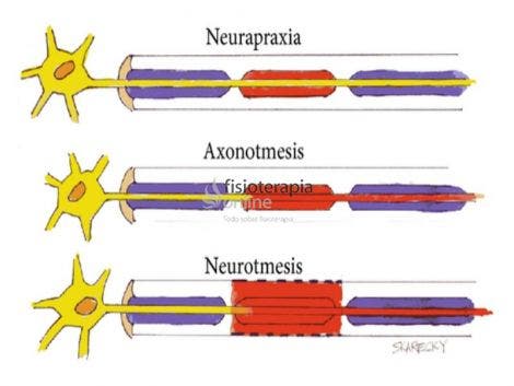 Axonotmesis | Qué es, qué estructuras afecta, síntomas, signos clínicos, causas y tratamiento ...