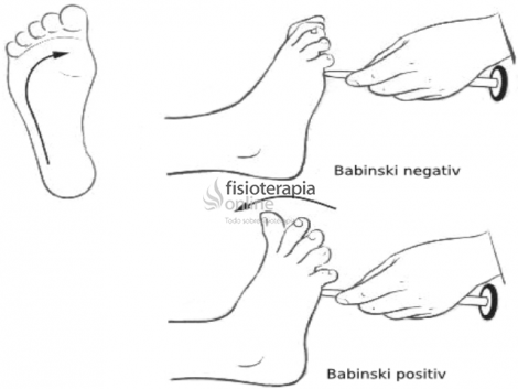 Babinski | Qué es, características, cómo se valora, tiempo de aparición ...