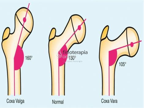 Coxa vara | Qué es, qué estructuras afecta, síntomas, signos clínicos, causas y tratamiento ...