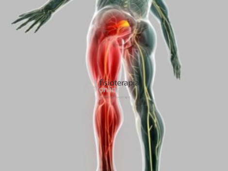 Dolor radicular | Qué es, características, en qué patologías aparece ...