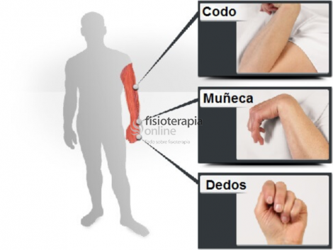 Espasticidad | Qué es, características, en qué patologías aparece, por ...