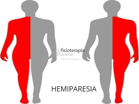 Hemiparesia | Qué es, qué estructuras afecta, síntomas, signos clínicos ...