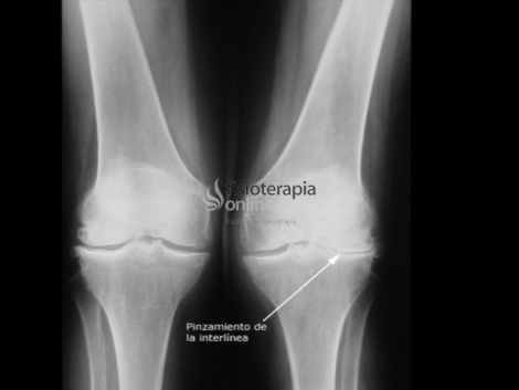 Interlínea articular | Qué es, ubicación y cuál es su función