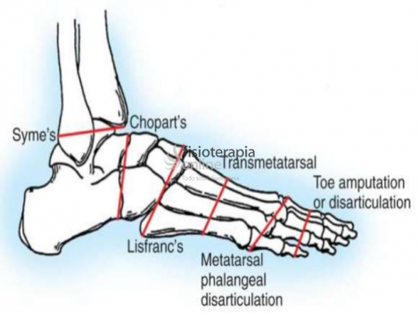 Interlínea Chopart | Qué es, significado, dónde se encuentra, función y ...