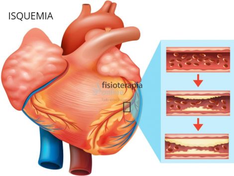 Isquemia | Qué es, características, en qué patologías aparece, por qué ...