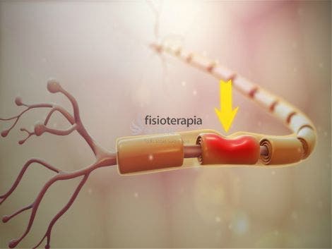 Neuropraxia | Qué es, qué estructuras afecta, síntomas, signos clínicos ...