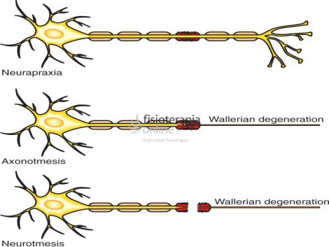 Neurotmesis | Qué es, qué estructuras afecta, síntomas, signos clínicos ...
