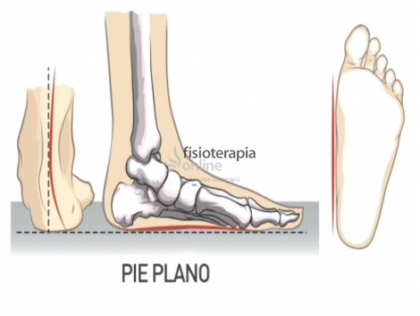 Pie plano | Qué es, causas, síntomas, a quién afecta y tratamiento