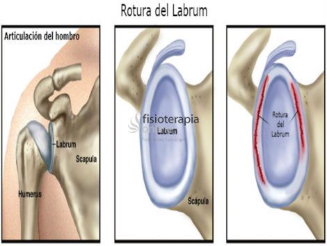 Rodete Glenoideo Qué Es Significado Ubicación Función Y Lesiones
